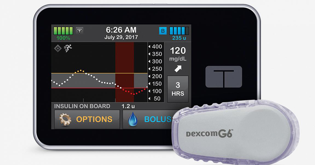 A New Artificial Pancreas System for People with Type 1 Diabetes - Blog ...