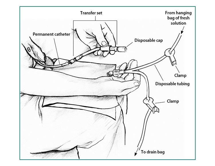 Peritoneal Dialysis | NIDDK