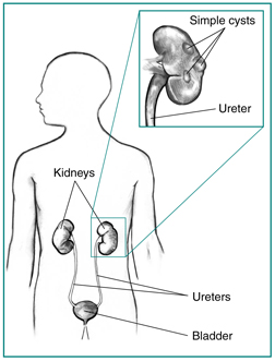 Simple Kidney Cysts | NIDDK