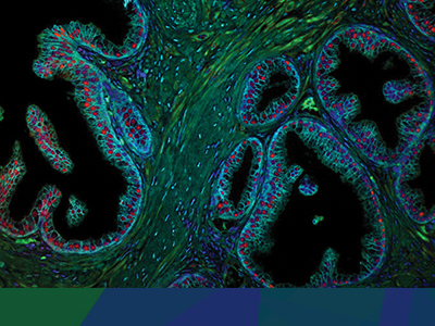 BPH and Male LUTS: Intersection between Pathology and Disease - 2022 ...