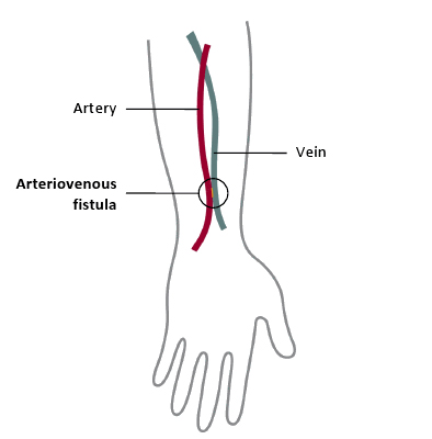 Dialysis Fistula Diagram