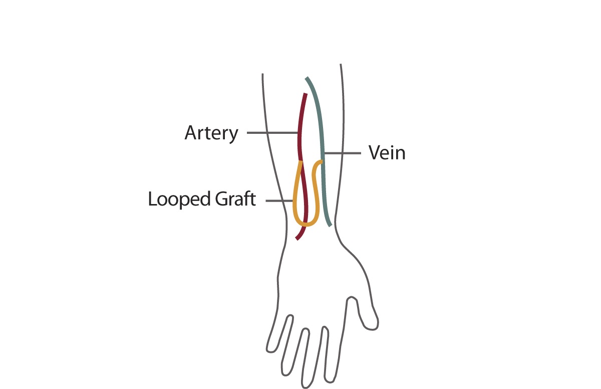 Graft Dialysis