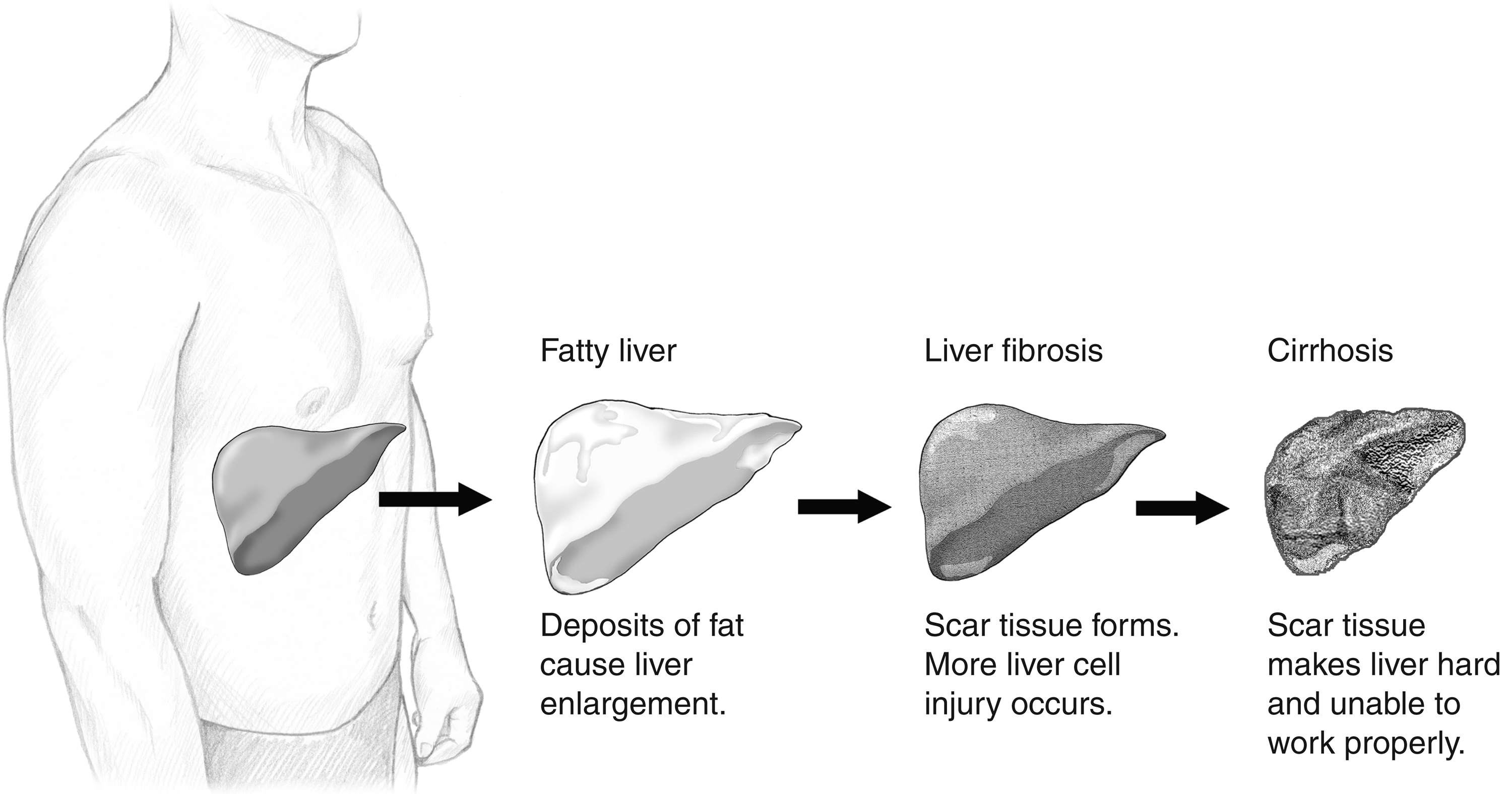 The Stages of Liver Damage: Normal Liver, Fatty Liver, Liver Fibrosis ...