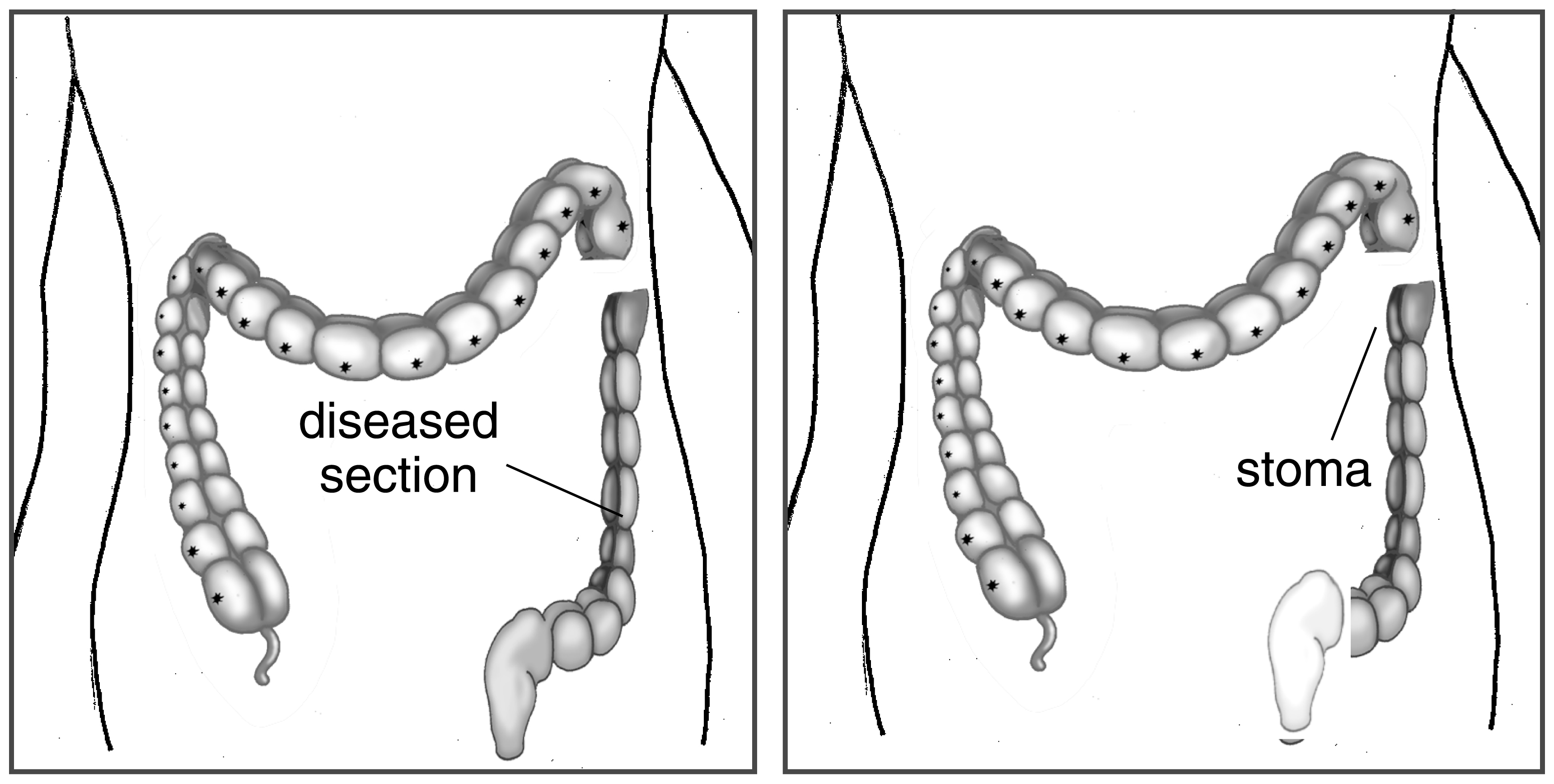 Ostomy Surgery Showing Diseased and Healthy Large Intestines | Media ...