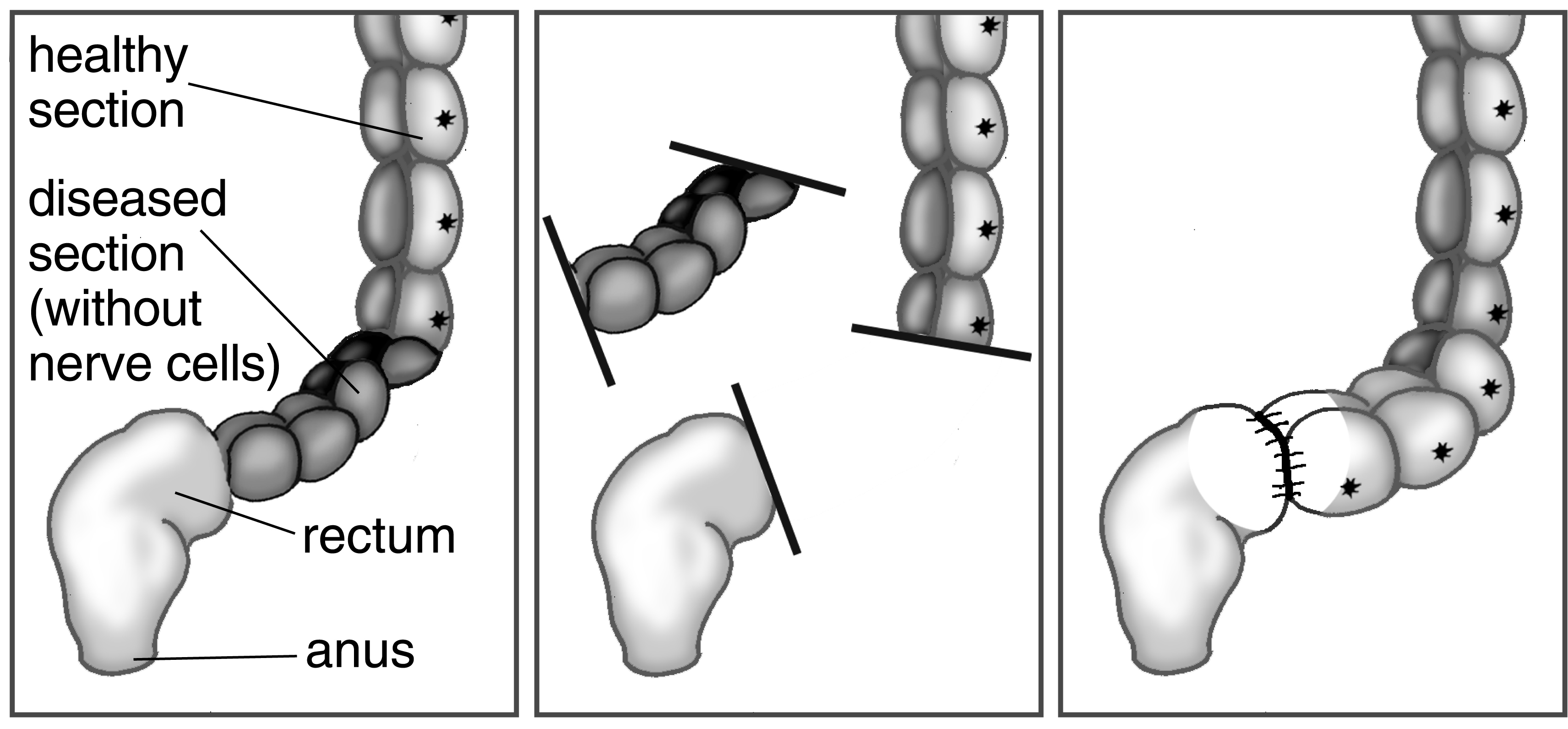 Surgery to Treat Hirschsprung’s Disease | Media Asset | NIDDK