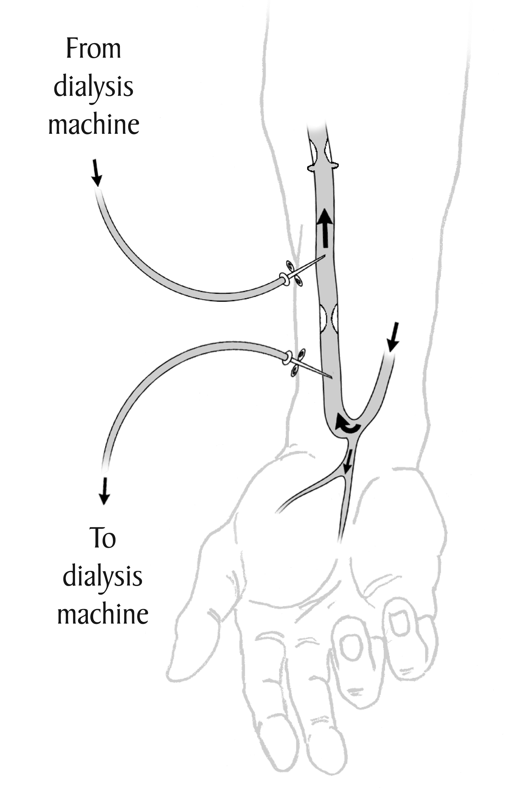 Dialysis Fistula Diagram