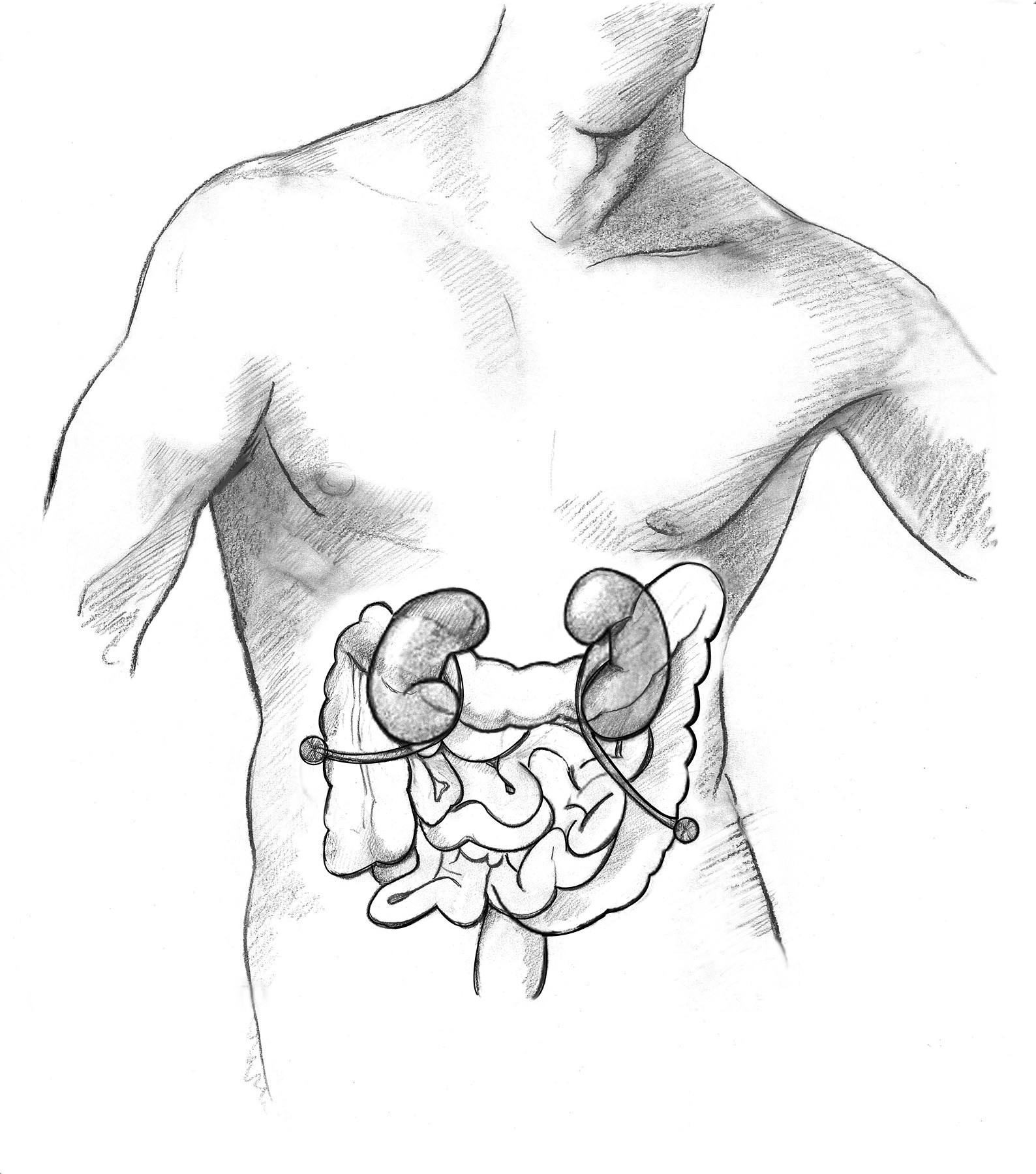 A ureterostomy with two stomas | Media Asset | NIDDK