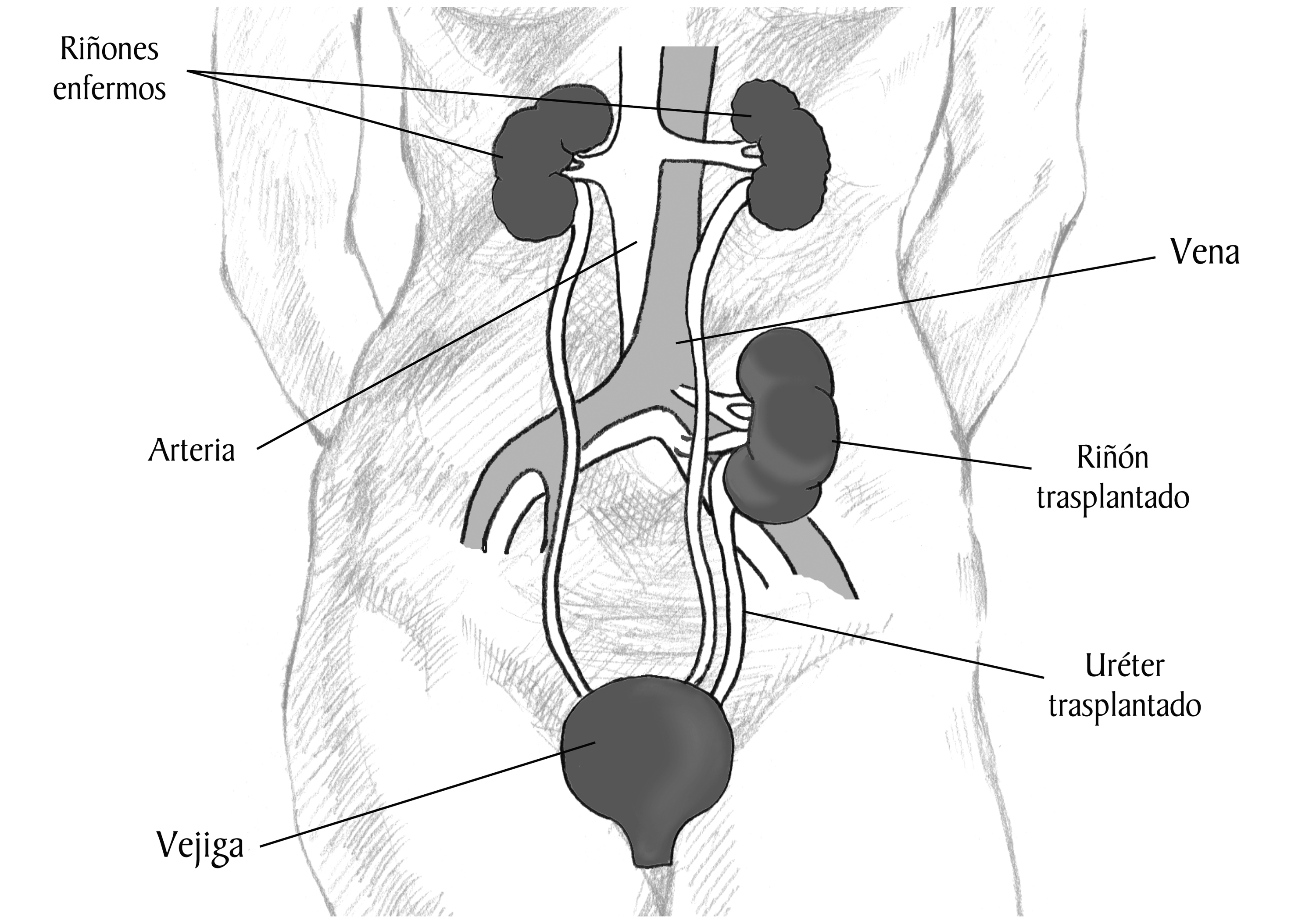 Muestra la localizacion de un rinon donado en la parte superior del ...