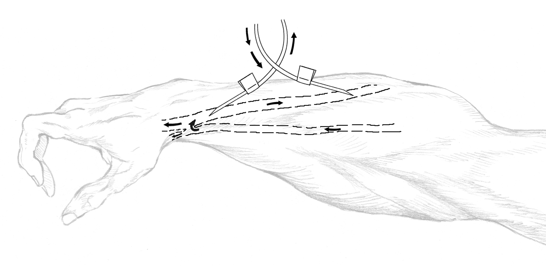 Forearm with needles inserted into the vascular access | Media Asset ...