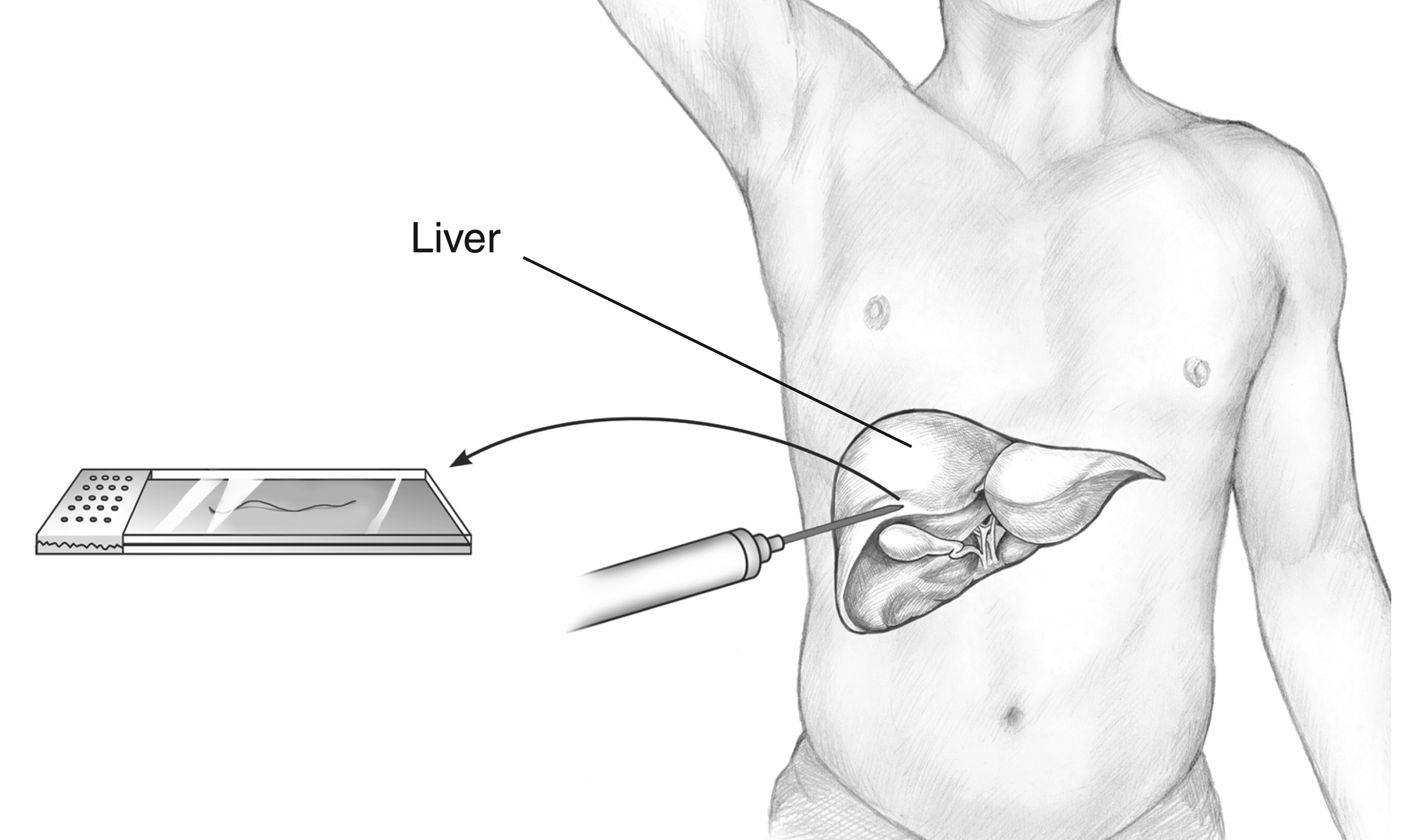 Liver Biopsy Procedure
