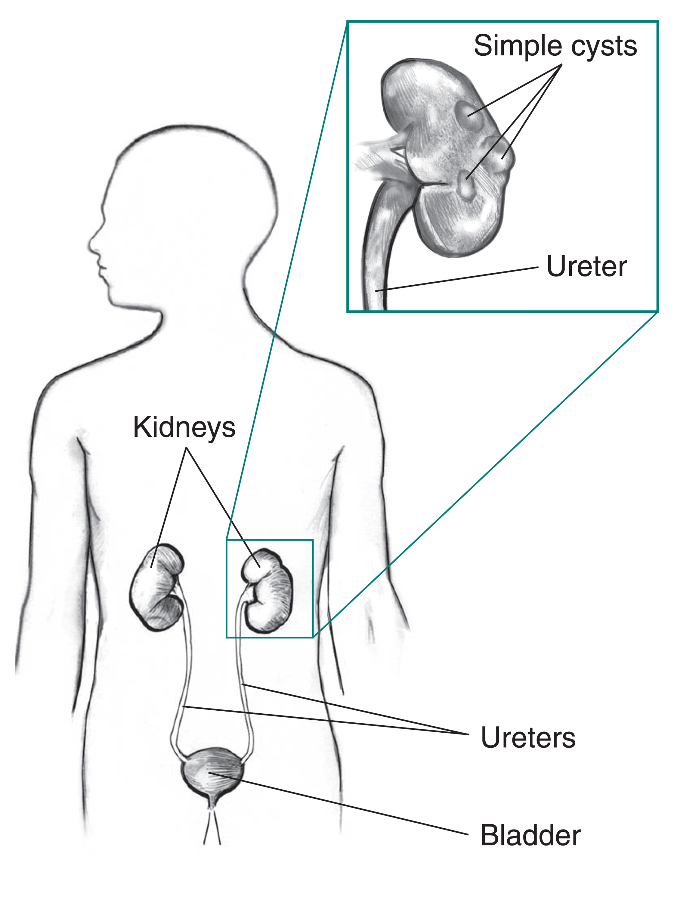 Urinary tract in the outline of a male figure and inset image of simple ...
