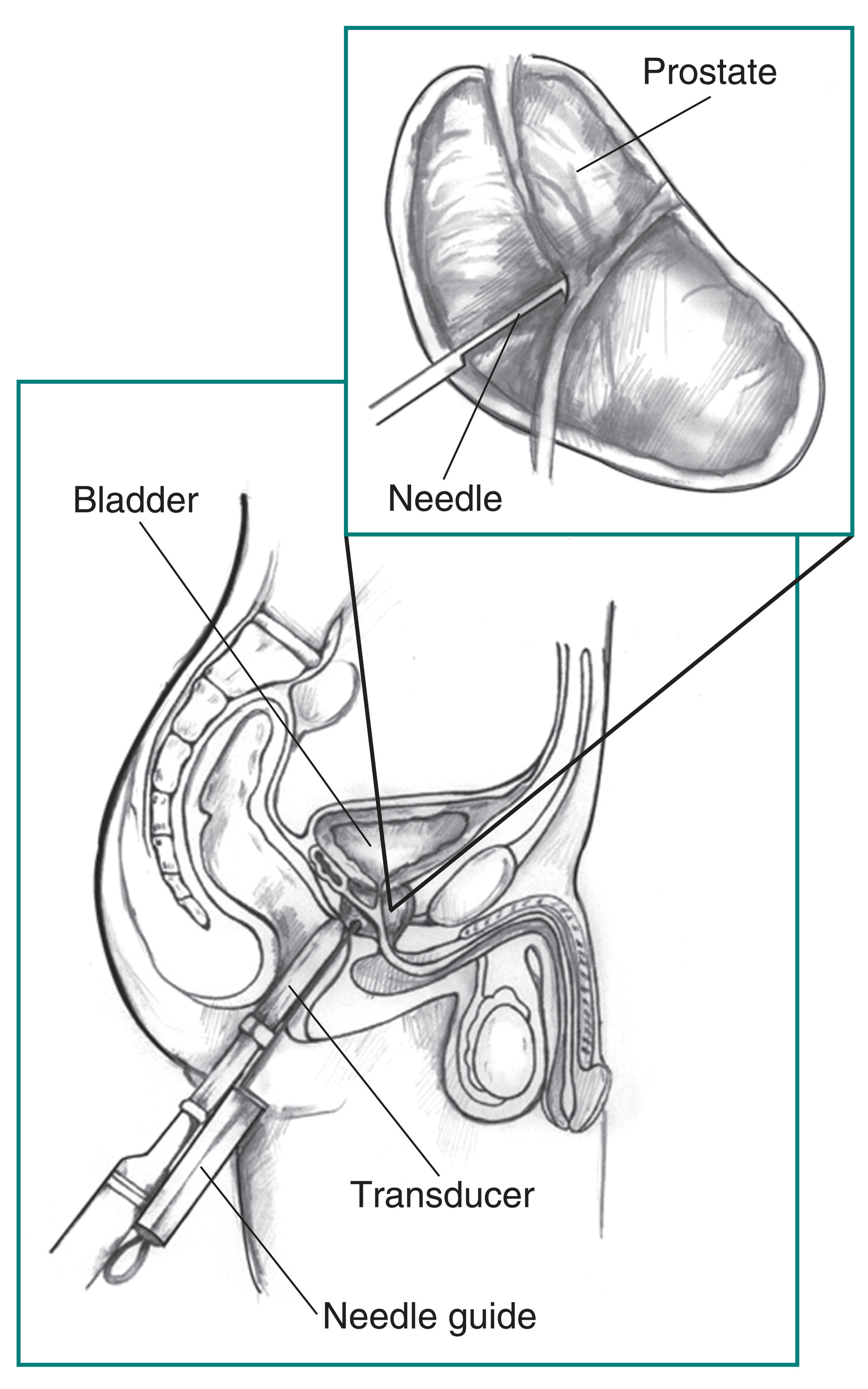 Transrectal Ultrasound Prostate Biopsy