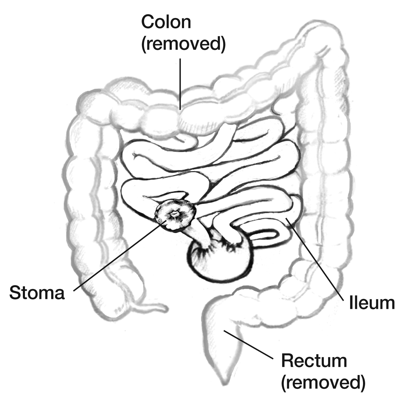Small intestine diverted through a pouch and then to a stoma with ...
