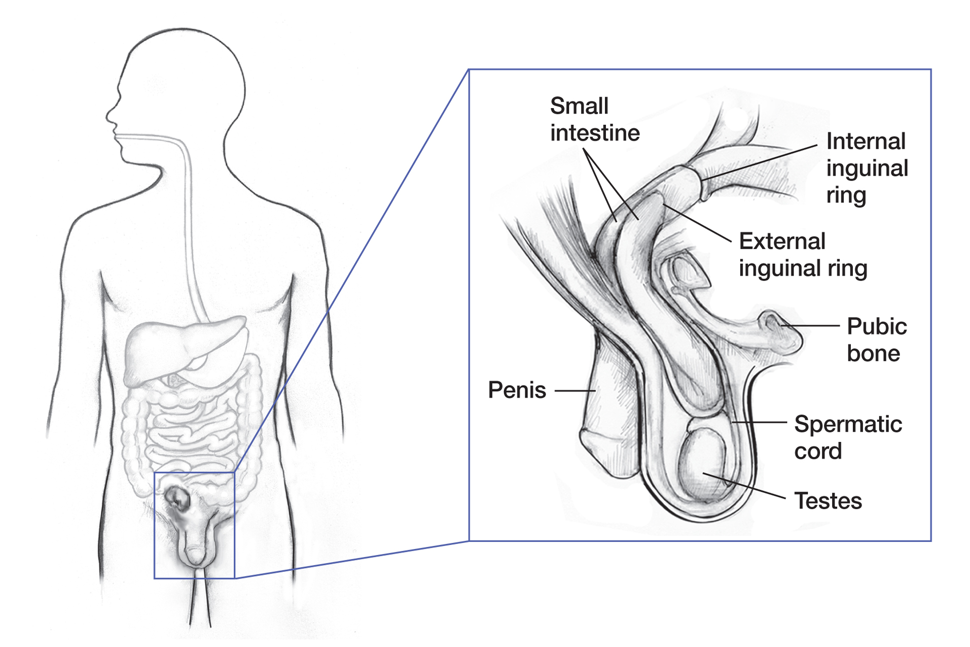 Male digestive tract with an inset showing an inguinal hernia with labels | Media Asset | NIDDK