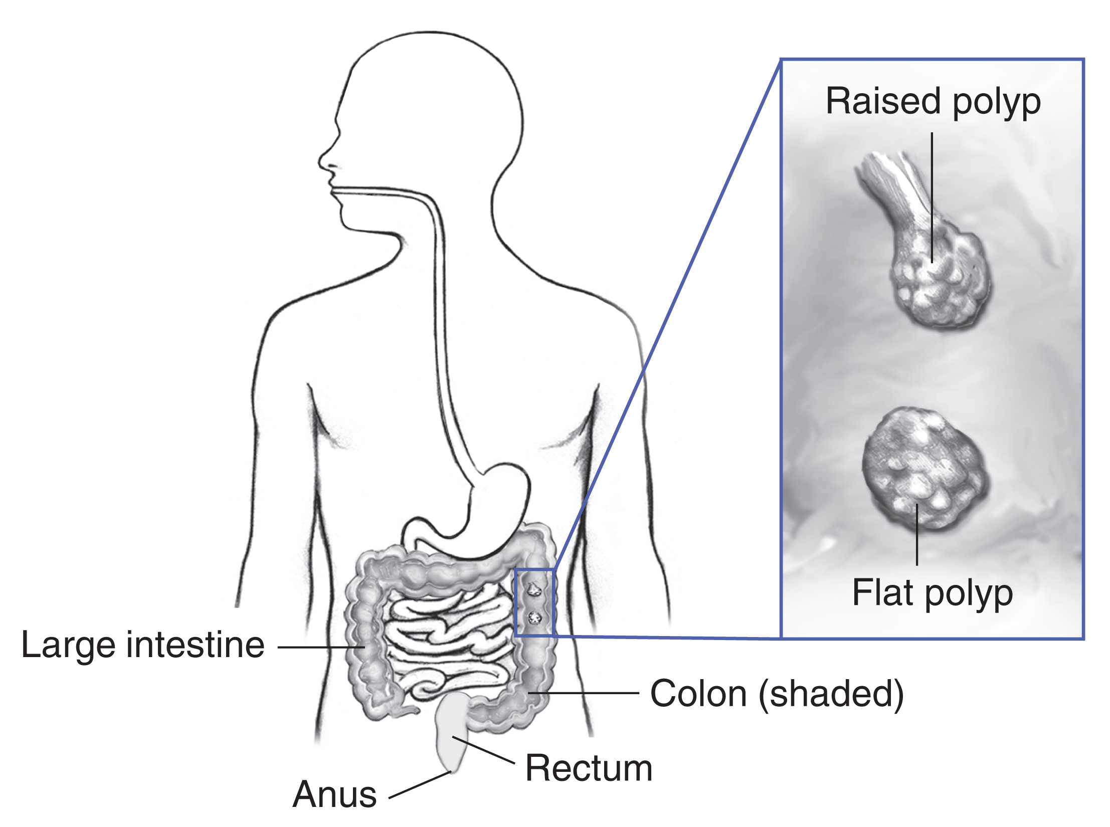 Digestive tract with labels and inset showing a section of colon with a ...