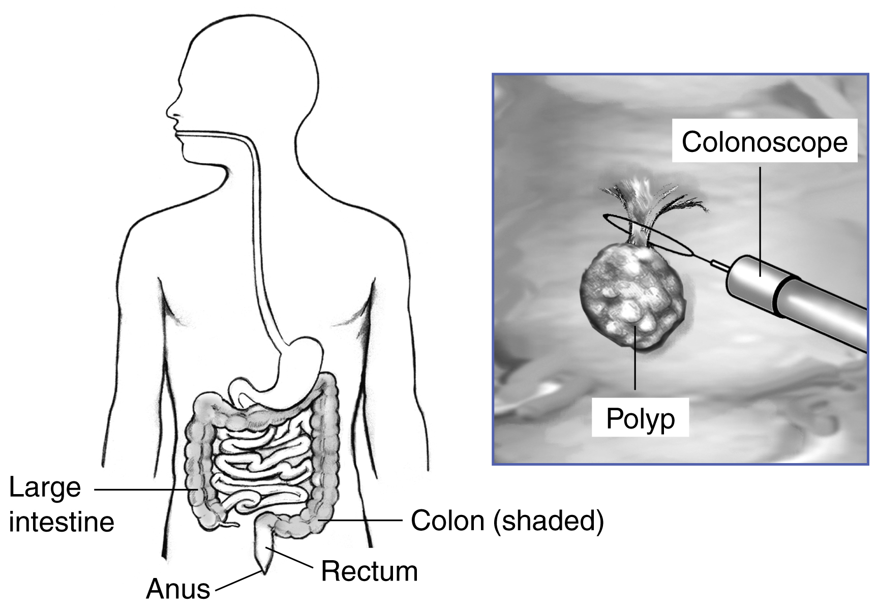 Digestive tract with labels an inset showing a colonoscope removing a ...
