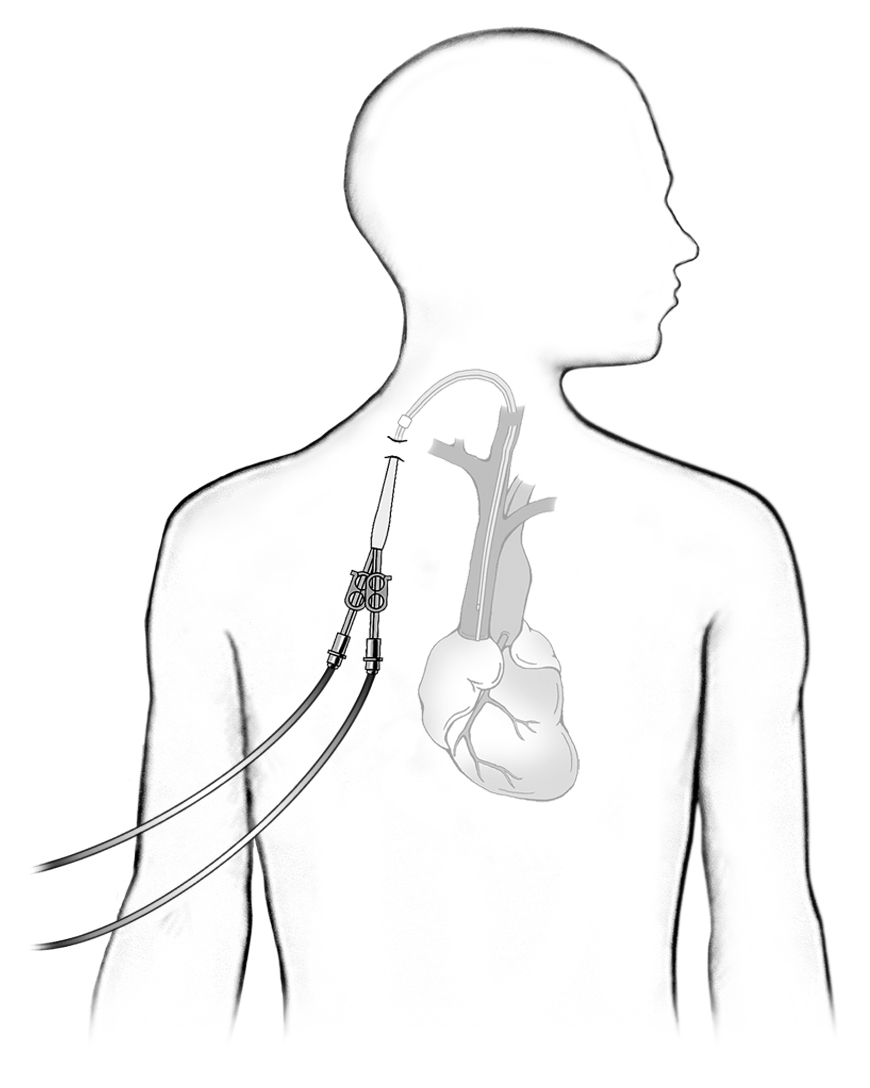Man with a venous catheter in his neck and tubes that connect to a hemodialysis machine | Media ...