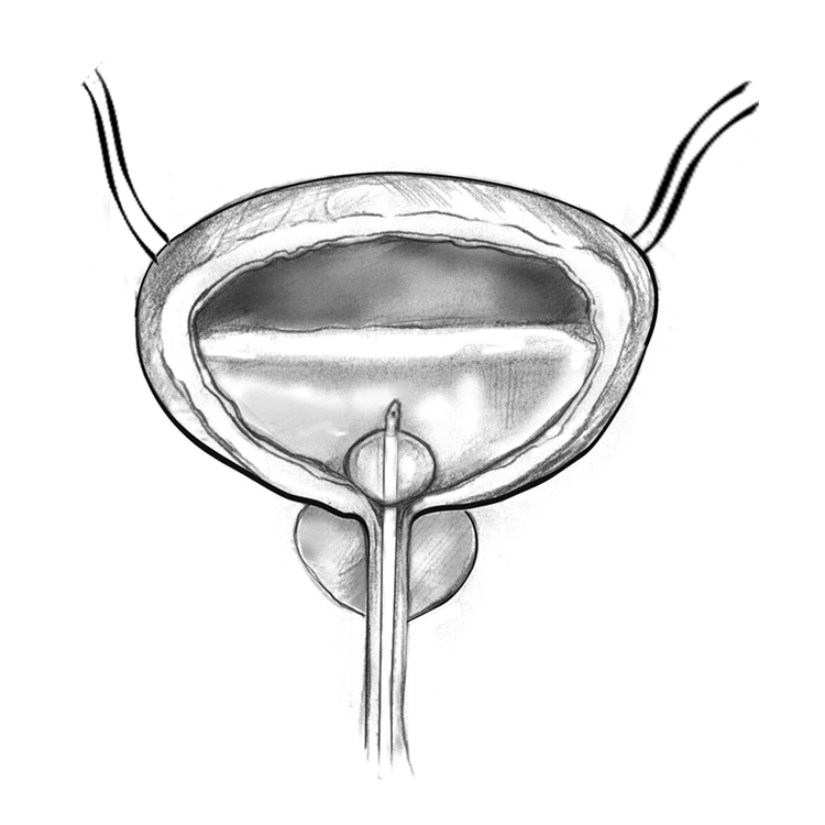 Bladder, prostate, and urethra, showing urine flow from the bladder ...